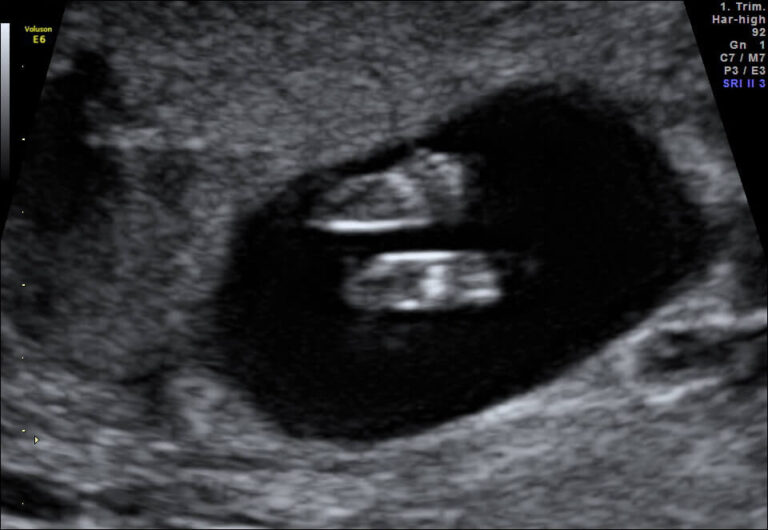 Ersttrimesterscreening & Combined Test - Precare